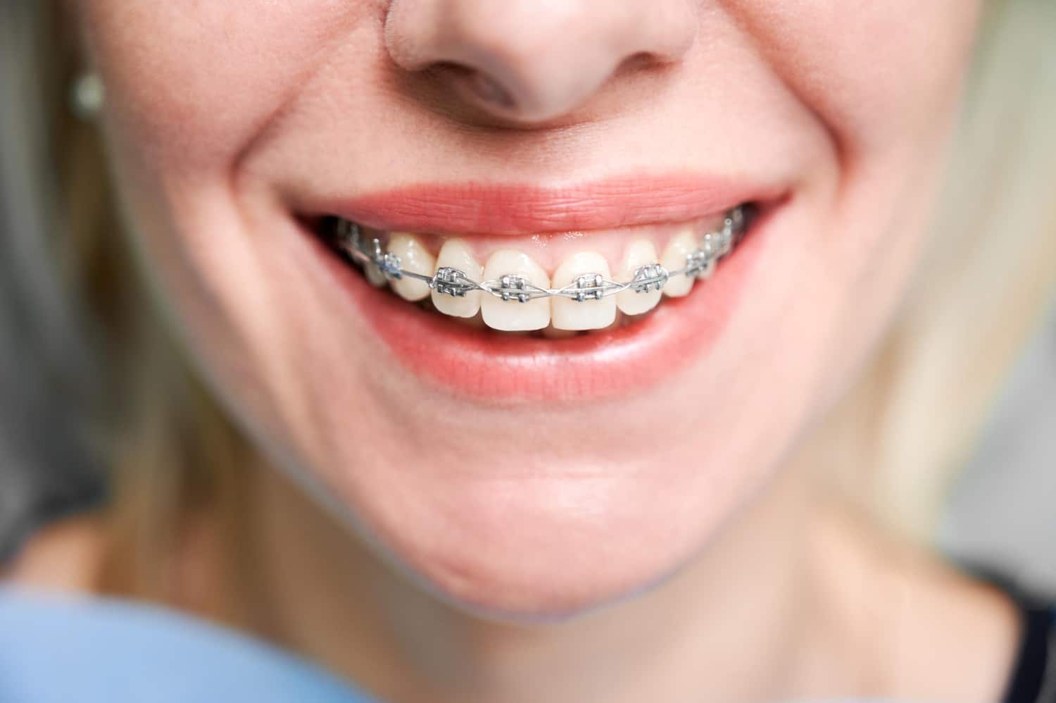Dental Braces Explained: A Complete Guide for First-Time Wearers ...