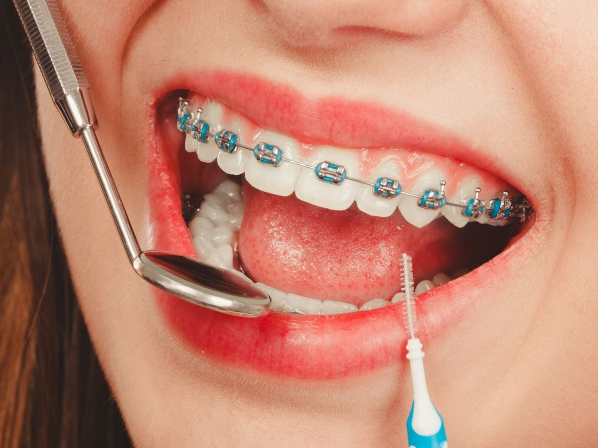 Braces and Retainers at Embrace Orthodontics